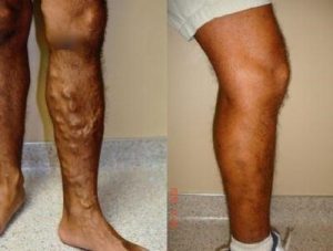 Compression Stockings – Northcliff Orthopaedic Centre