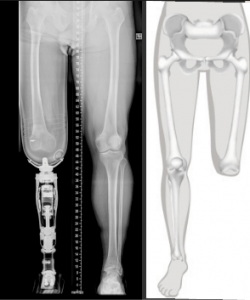 Through knee Prosthetics – Northcliff Orthopaedic Centre